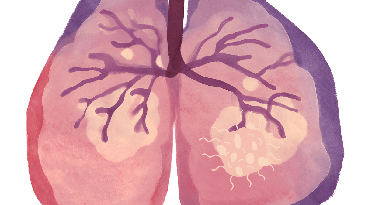 Understanding Bronchogenic Carcinoma (Lung Cancer) – pathoscribe